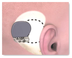 Esteem Implanted Hearing Aid From Envoy Gets Approval from the FDA ...